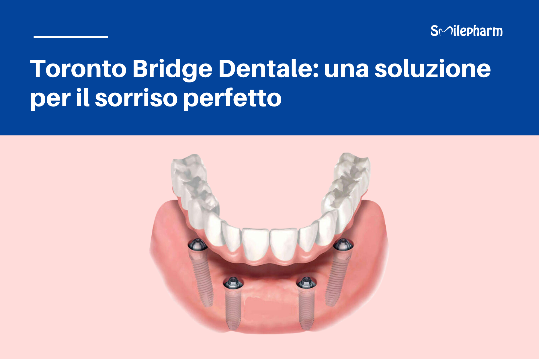Toronto Bridge Dentale: una soluzione per il sorriso perfetto - Smilepharm
